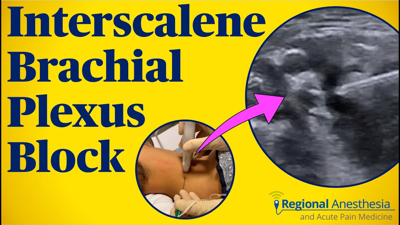 Interscalene Brachial Plexus Block
