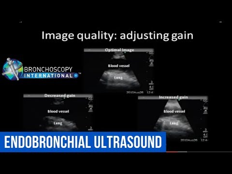 EBUS Physics Video - Endobronchial Ultrasound