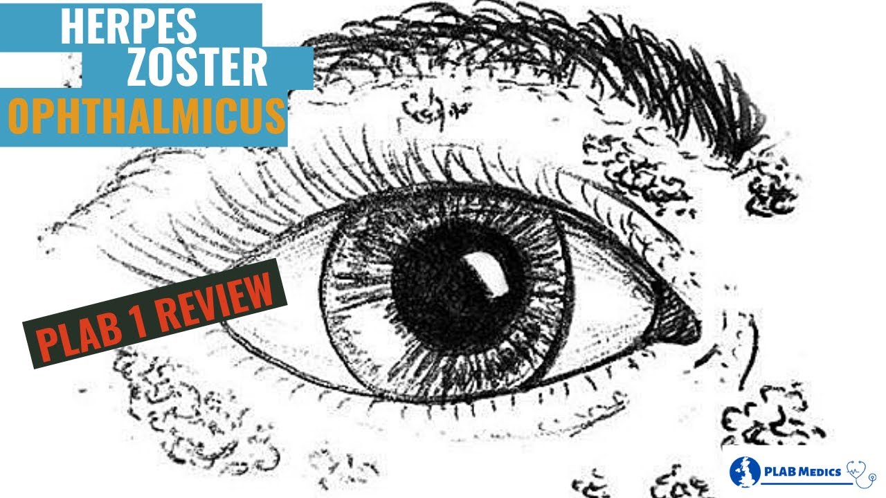 Herpes Zoster Ophthalmicus (PLAB 1 Ophthalmology Review)