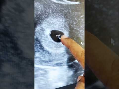 Early pregnancy scans || baby growth on scan || Dr. Silpahasa Samalla | gynaecologist | doctorsvlog