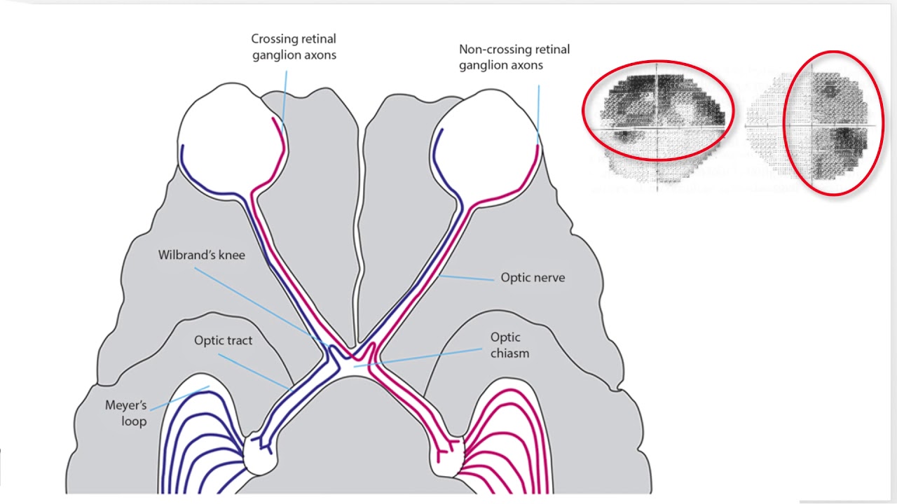 RS Vision Pathway Part 4 - Chiasmal Segment