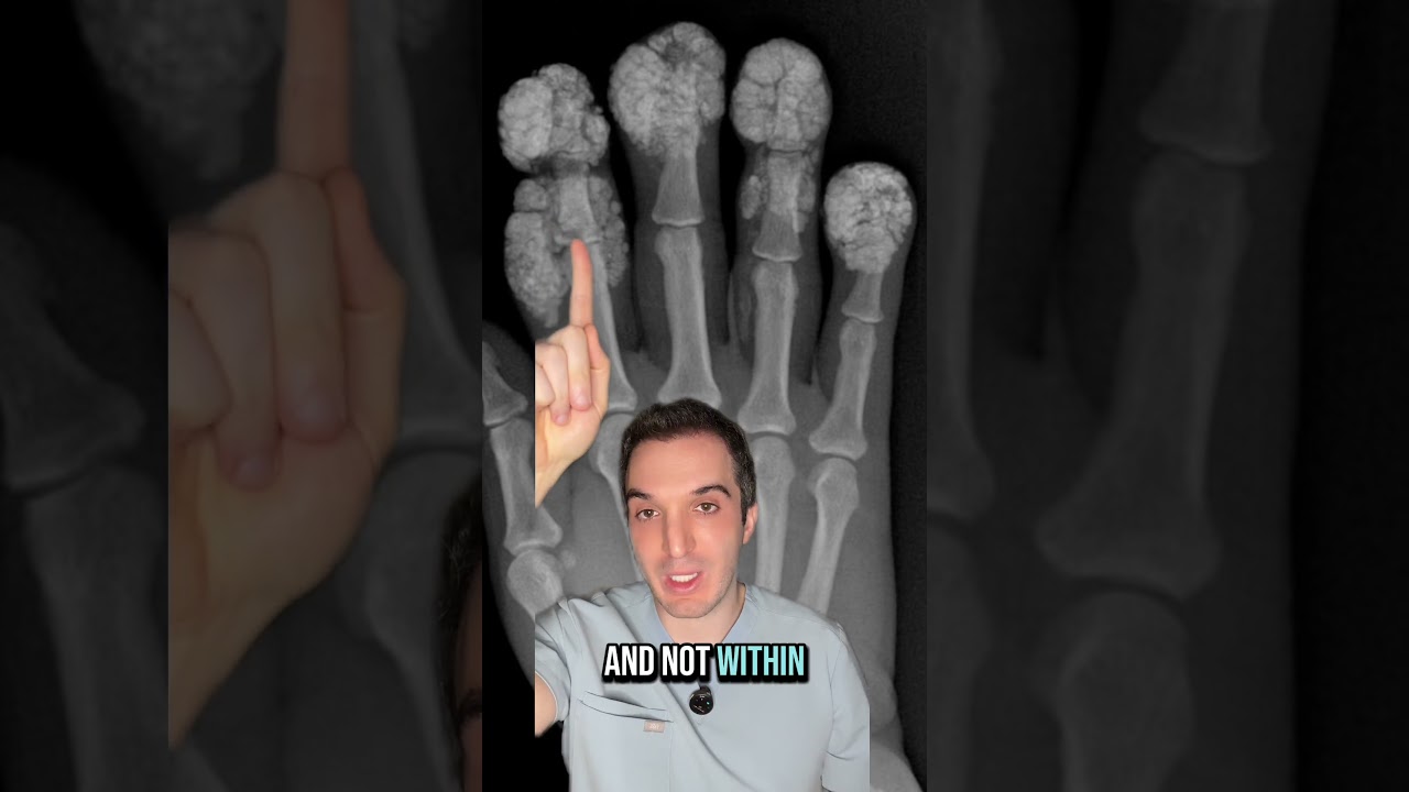 Fascinating scleroderma x-ray 🖐️ 🤚