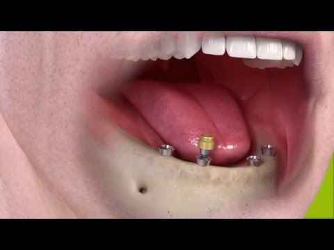 Full Missing Arch - Implant Supported Dentures with Locator | Straumann Thailand