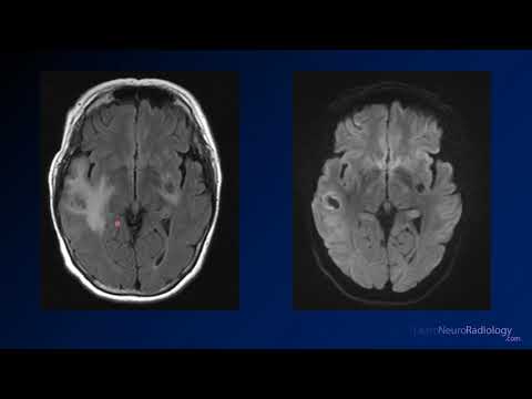 Imaging brain tumors - 5 - Non glial tumors