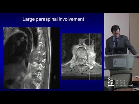 En Bloc Resection for Primary Spinal Tumors – Spine 101