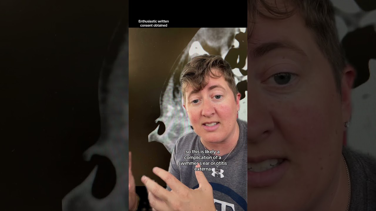 This is a complication of swimmer’s ear or otitis externa!