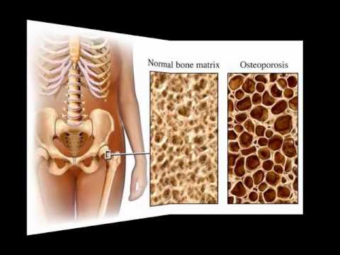 Bone remodeling (Bob and Claude)