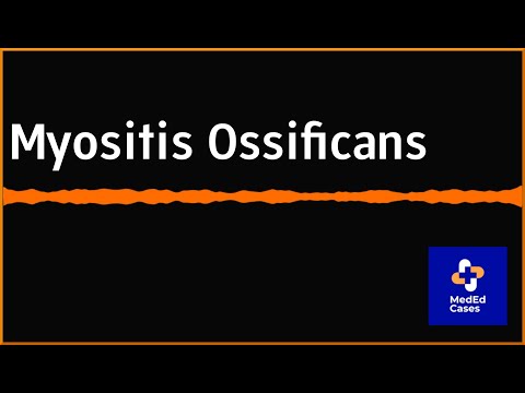 Myositis Ossificans - Review Pod
