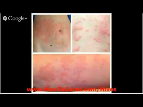The best approach to treat your Dermatographic Urticaria is to find out ...