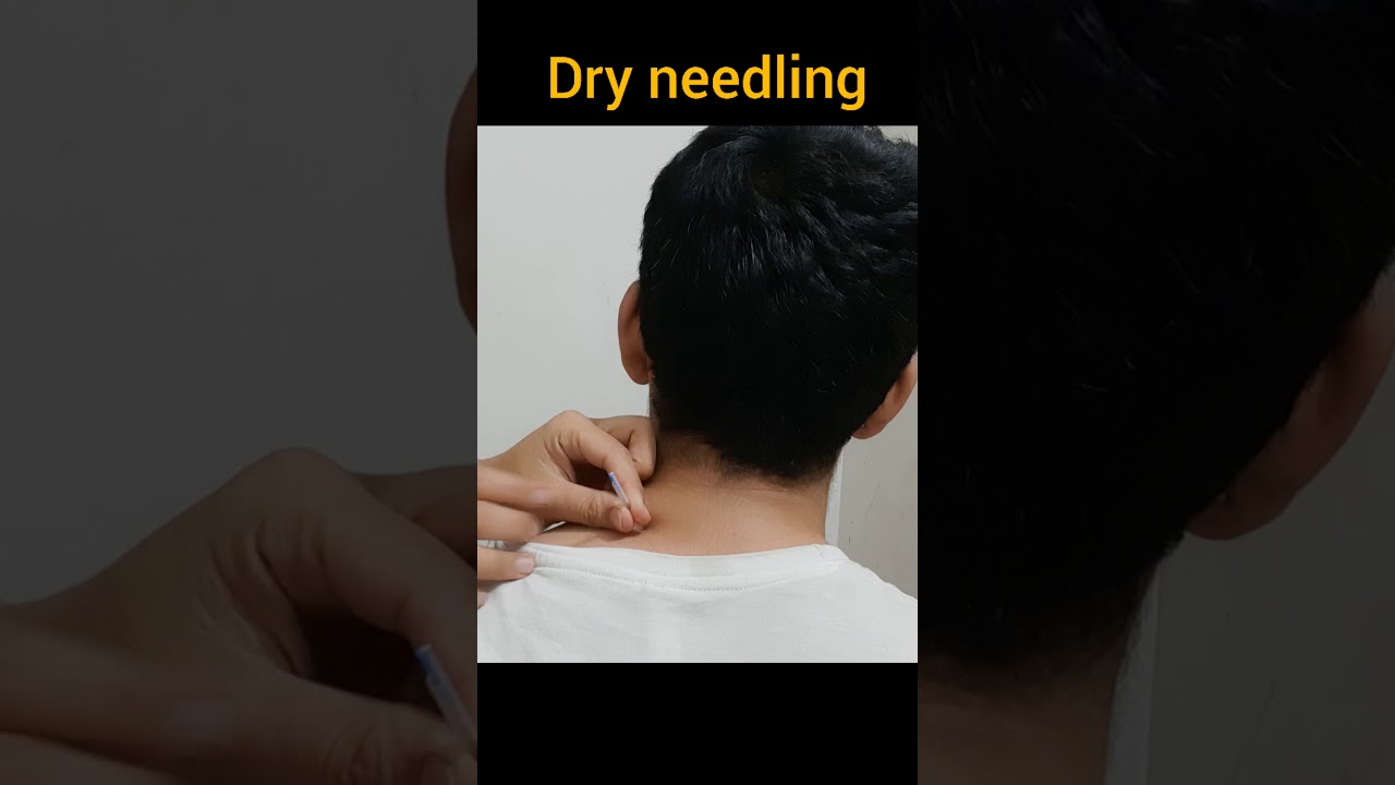 Dry Needling therapy used to break Trigger points