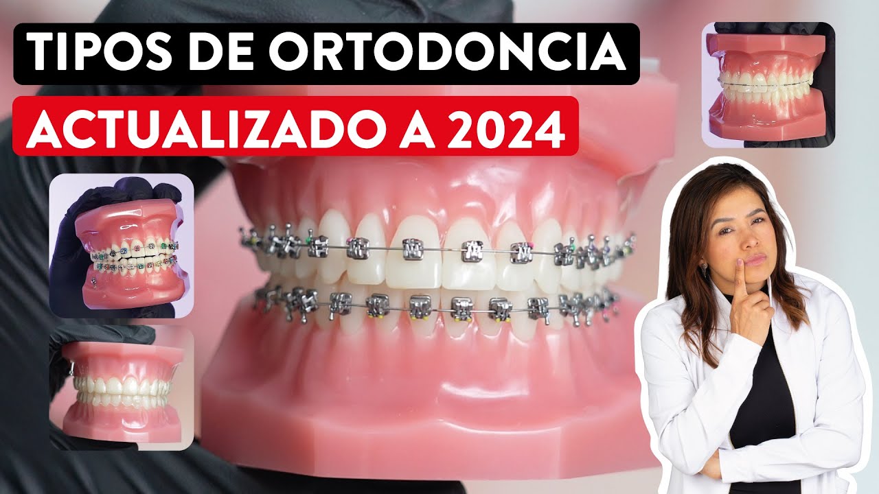 Tipos de Ortodoncia actualizado a 2024  ✅