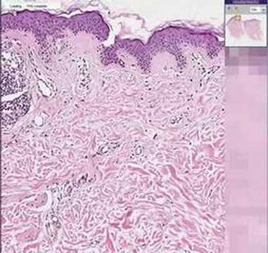 Histopathology Skin--Compound nevus with halo reaction