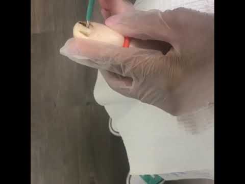 Biopsy of Subungual Melanoma