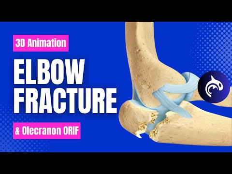 Elbow (Olecranon) Fracture and Fixation - 3D Animation
