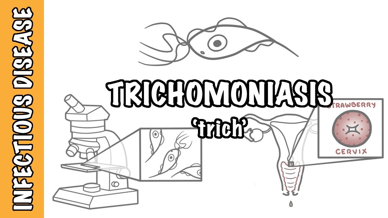 Trichomoniasis | Causes, Symptoms, Diagnosis & Treatment | STI Explained by Doctor