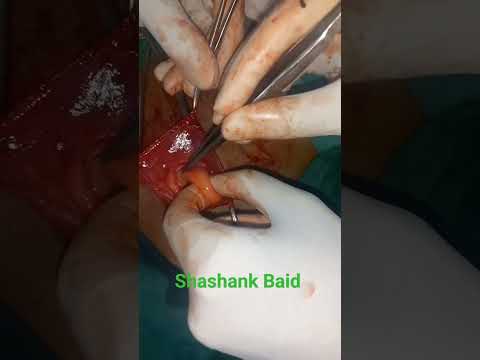 Left sided sliding inguinal hernia containing urinary bladder