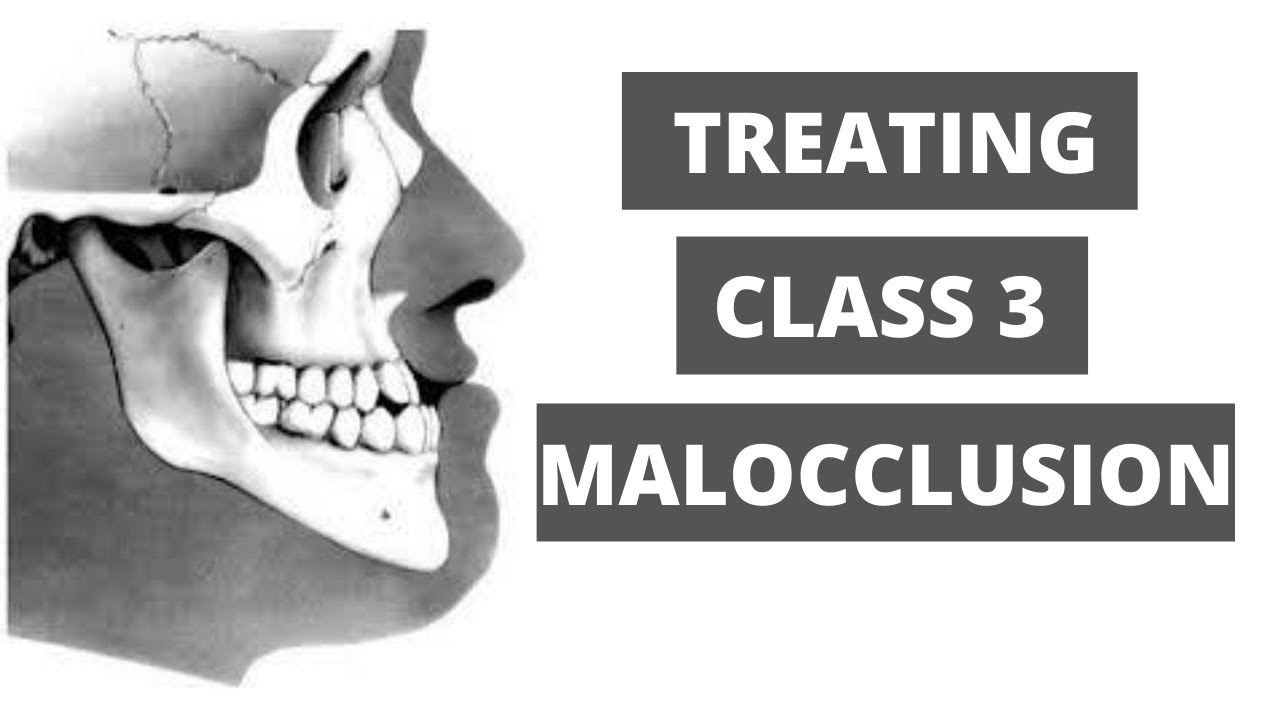 Management of Class 3 Malocclusion -Orthodontics