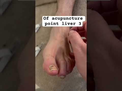 Deep acupuncture needling for stress and muscle tension #acupuncturepoints liver 3
