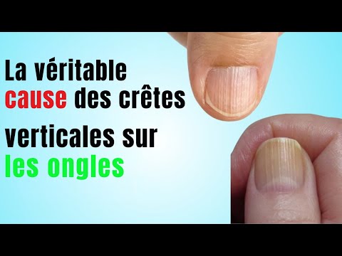Des stries sur les ongles ? Voici comment faire la part entre normal et ...