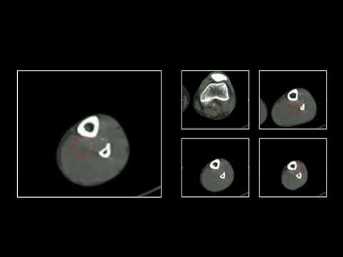 CTA Extremity Pt. 2 | Free Radiology CME