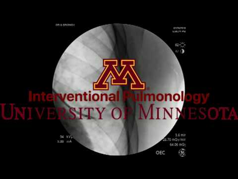 Transbronchial Forcep Biopsy with SuperDimension
