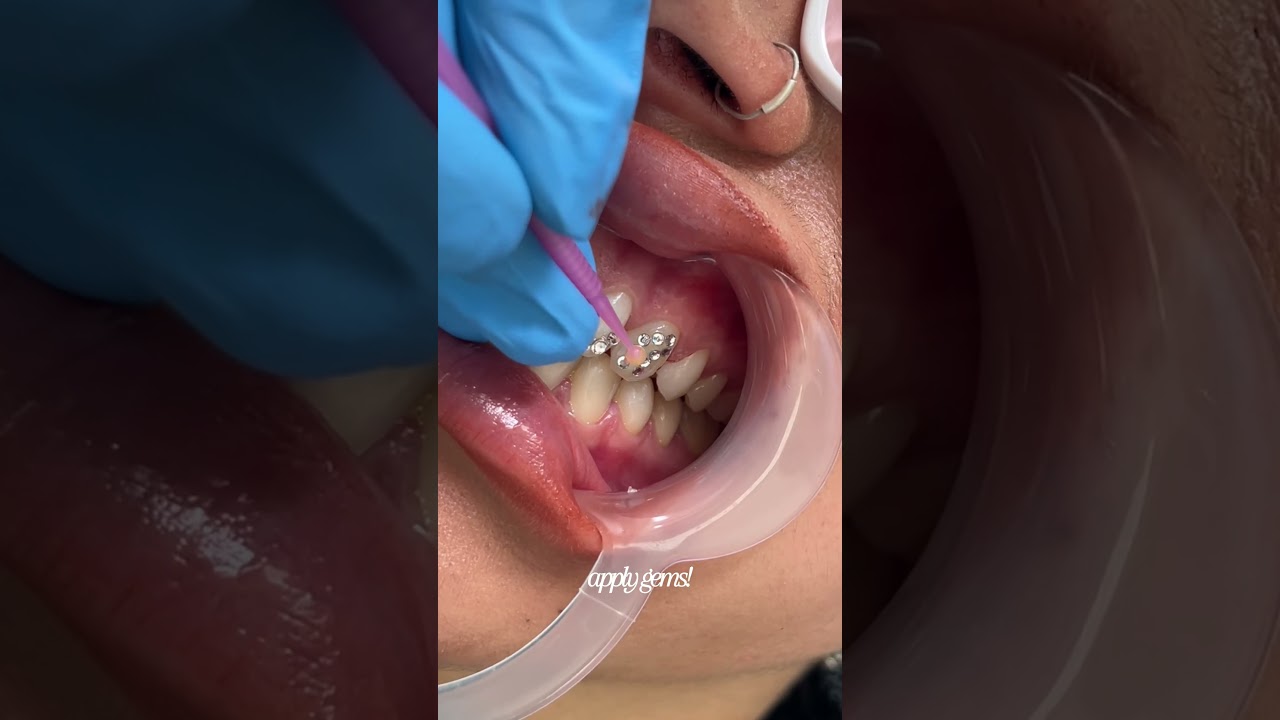 tooth gems process #toothgems #torontotoothgems
