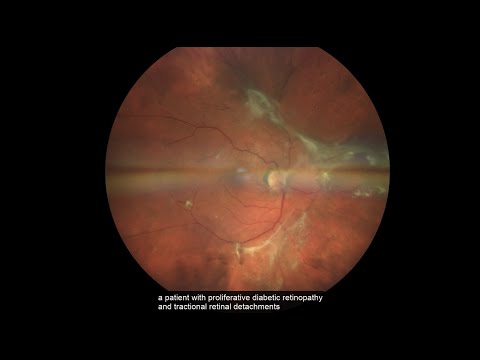 Proliferative Diabetic Retinopathy and Tractional Retinal Detachment