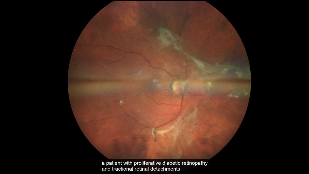 Proliferative Diabetic Retinopathy and Tractional Retinal Detachment
