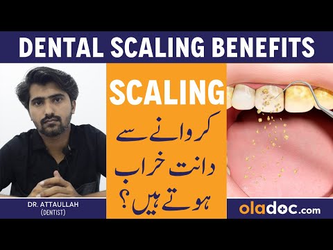 Benefits Of Scaling In Urdu//Hindi - Dentist Se Danto Ki Safai - Scaling Ke Fayde - Teeth Cleaning