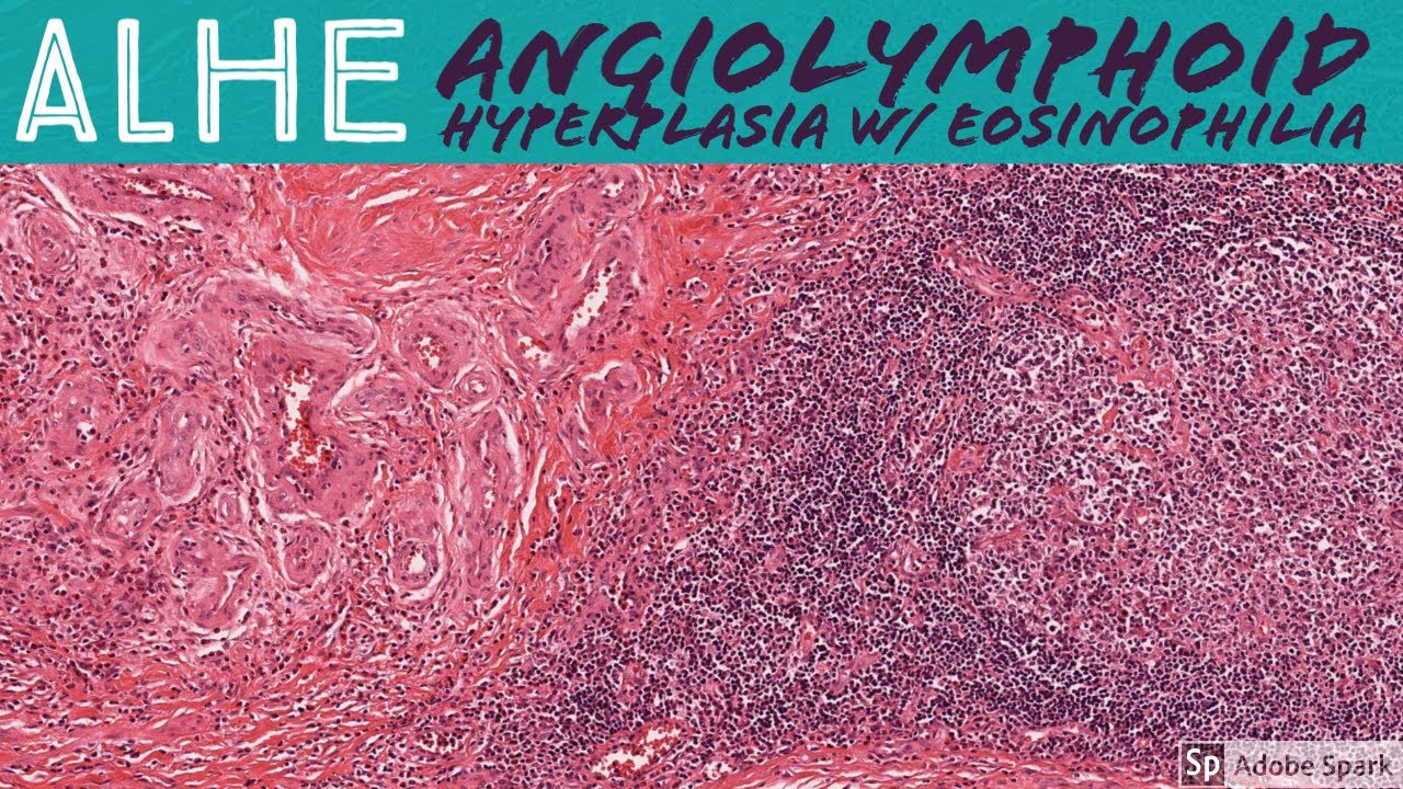 ALHE (Angiolymphoid Hyperplasia with Eosinophilia): 5-Minute Pathology Pearls