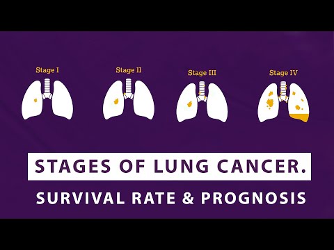 Stages of Lung Cancer. Survival rate & Prognosis. | Episode 5