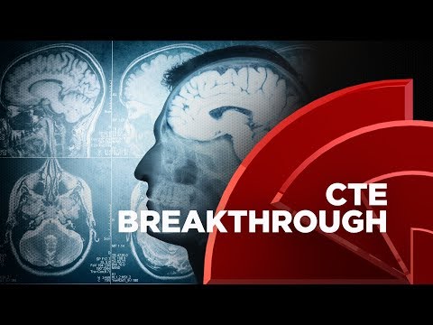 New Findings May Allow Doctors To Diagnose CTE, Dr. Bennet Omalu Weighs In On The Research