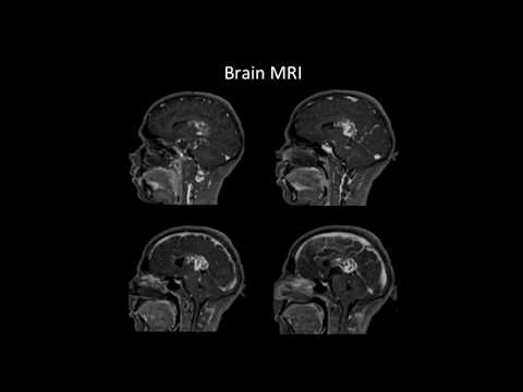 Microsurgical treatment for arteriovenous malformation of the corpus callosum and choroidal fissure