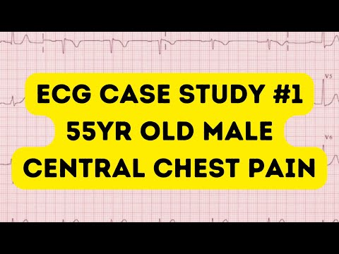 ECG Case Study #1: 55yr old Male, Central Chest Pain, What Would Your Diagnosis of the ECG Be?