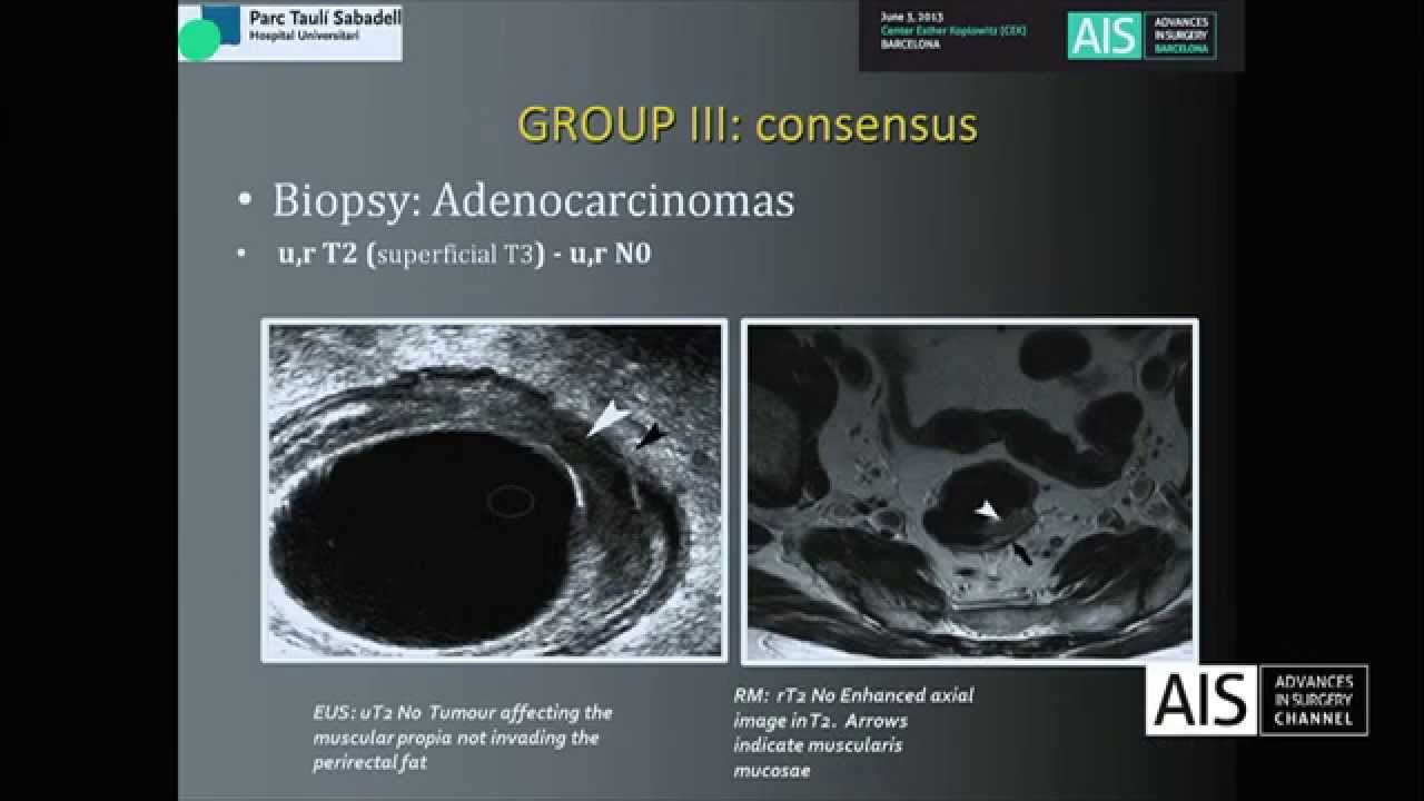 Local Treatment in Rectal Cancer: When and How? - Dr. Xavier Serra