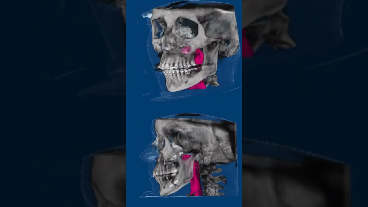 Mandibular advancement surgery - Did you know?