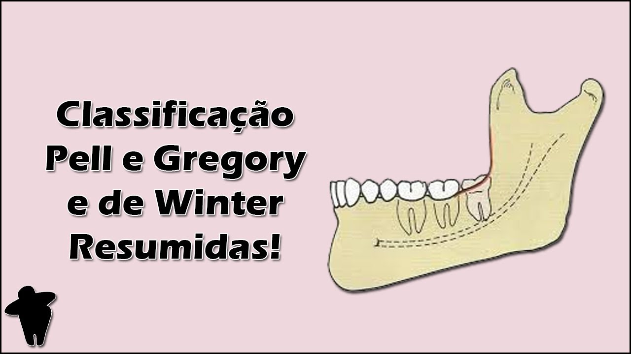 Classificação Pell e Gregory e de Winter - Como Avaliar a Dificuldade de Extração do Terceiro Molar