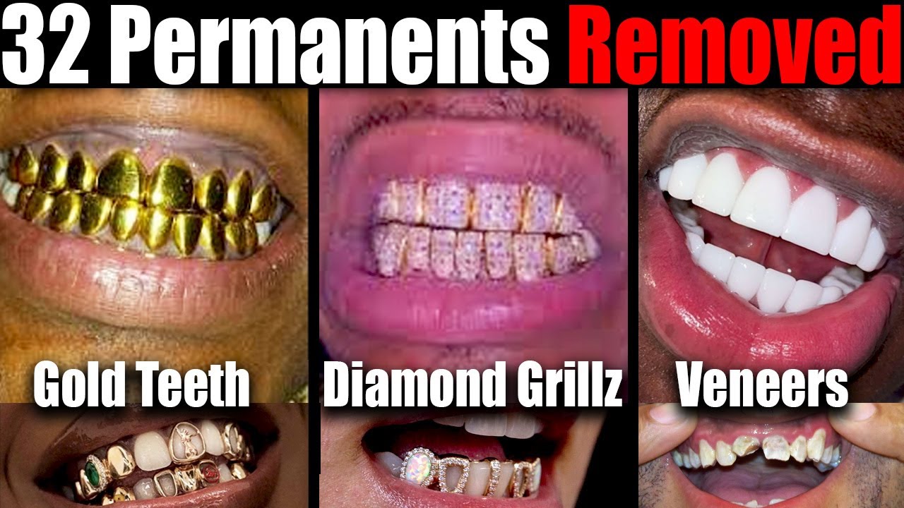 32 Permanent Gold Teeth Removed After 20 Years, The Effects Of Permanent Grillz