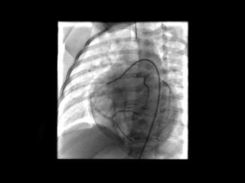 ALCAPA - RCA selective injection