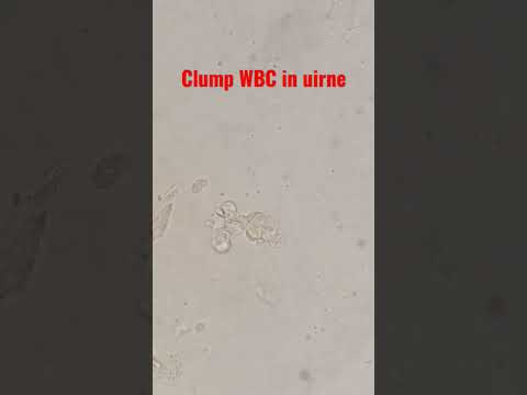 Clump WBC in urine #microscope #cls #lab #laboratory #wbc