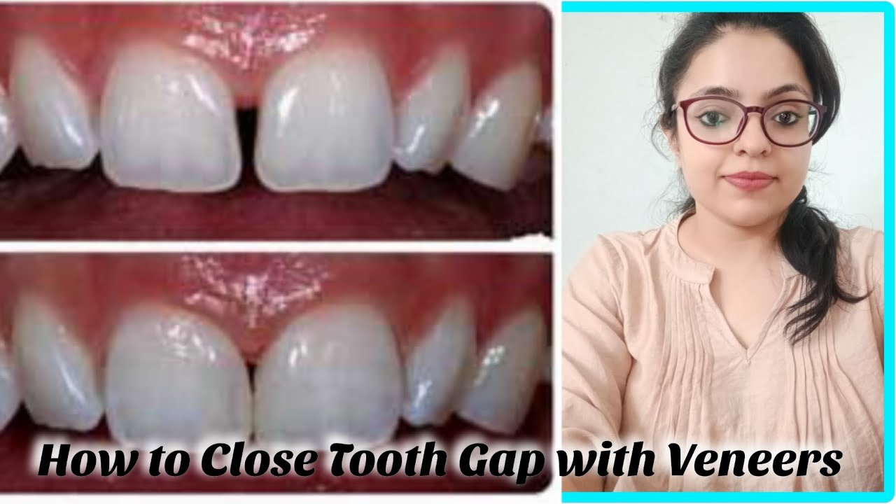 Teeth Gap? How to close multiple teeth Gaps with Veneers?