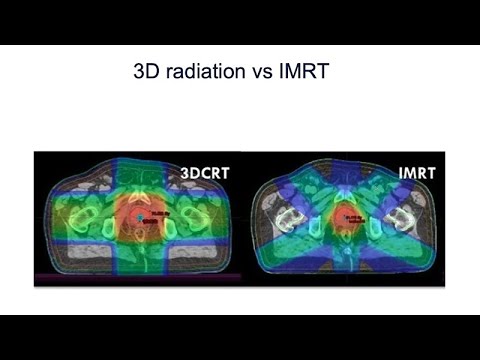 Radiotherapy for Localized Prostate Cancer