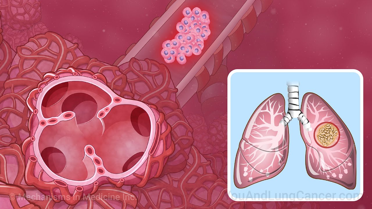 Understanding Non-Small Cell Lung Cancer - updated 2025