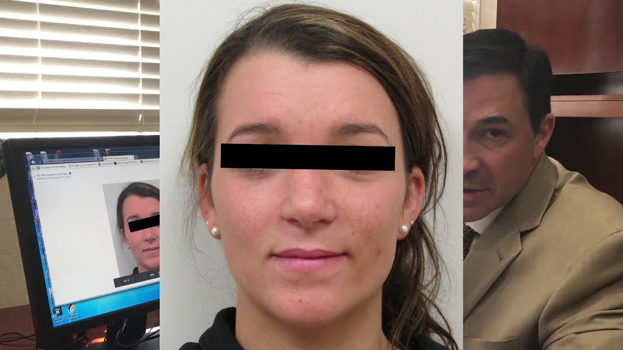 Dr. Fodero Discusses Revision Rhinoplasty - Before and Afters