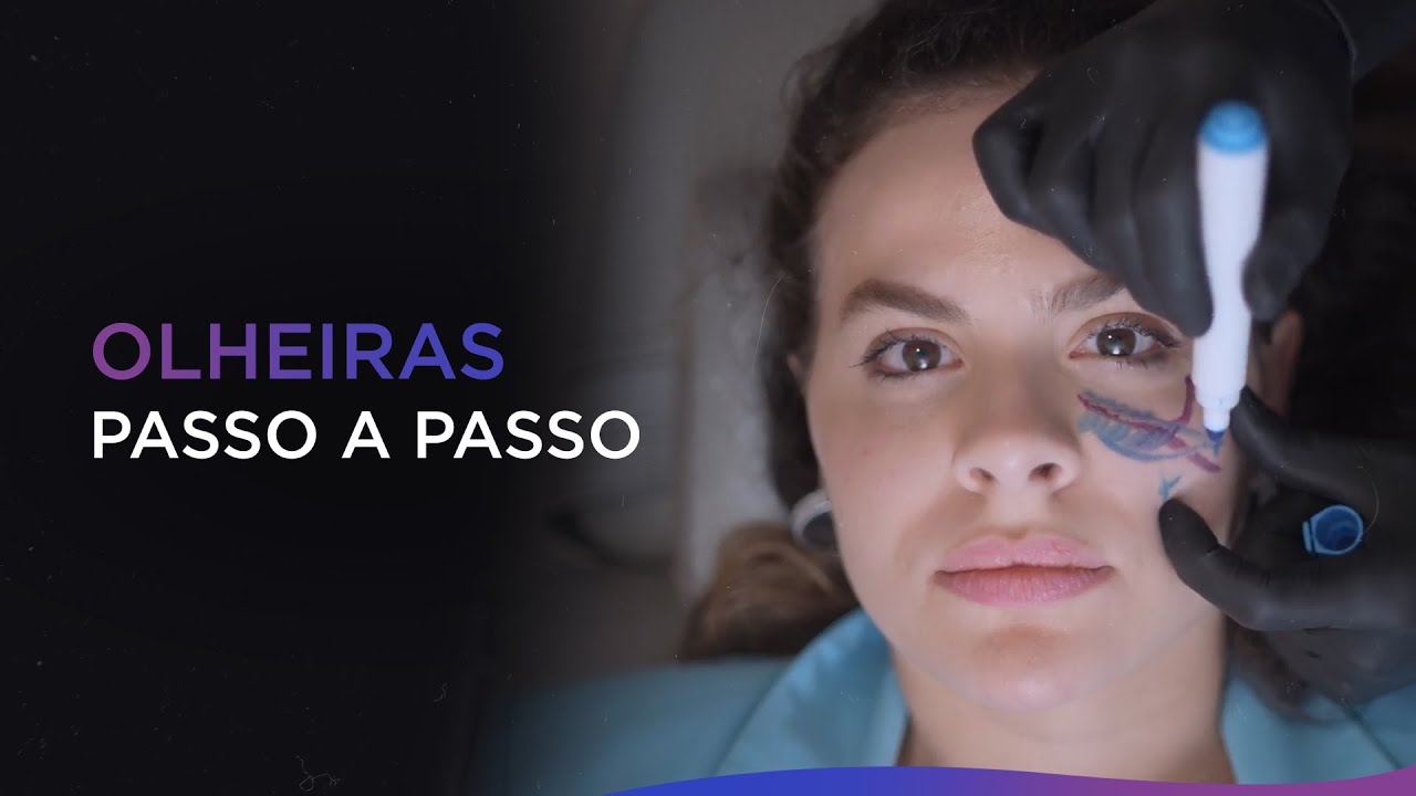 Preenchimento de olheiras: Técnica passo a passo