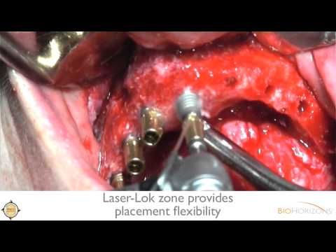 Full Maxillary Arch using Tapered Internal with Laser-Lok