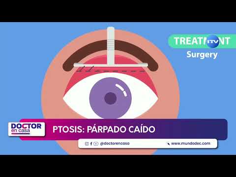 Ptosis: ¿Cuáles son las causas del párpado caído? | Doctor en Casa