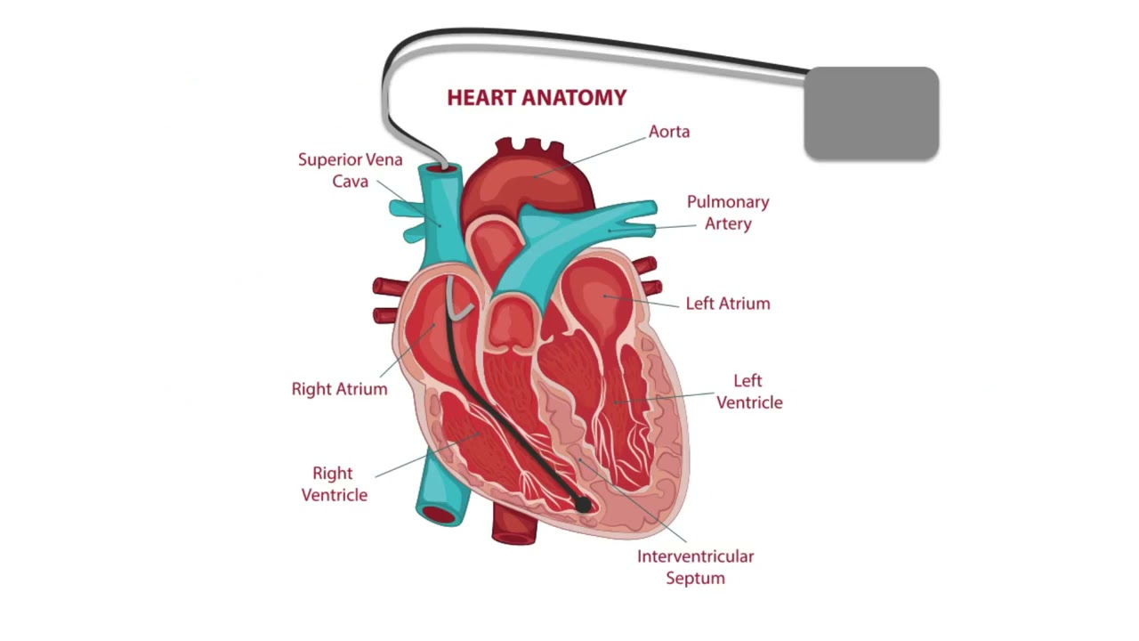 Common pacemaker problems part 2  Undersensing