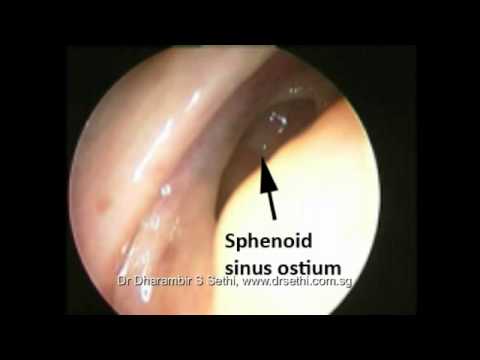 Diagnostic Nasal Endoscopy Acute Frontal Sinusitis