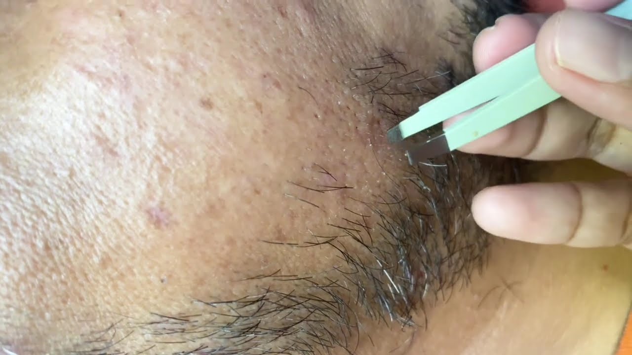 ASMR Plucking Beard Daily Routine Satisfying #plucking #pluckingasmr #plucker